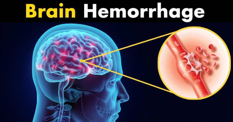 Brain Haemorrhage - Narain Hospital